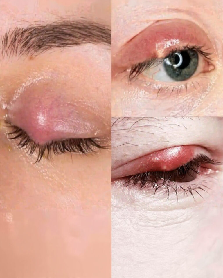 How to Treat a Painful Stye at Home Fast | Safe & Effective Remedies